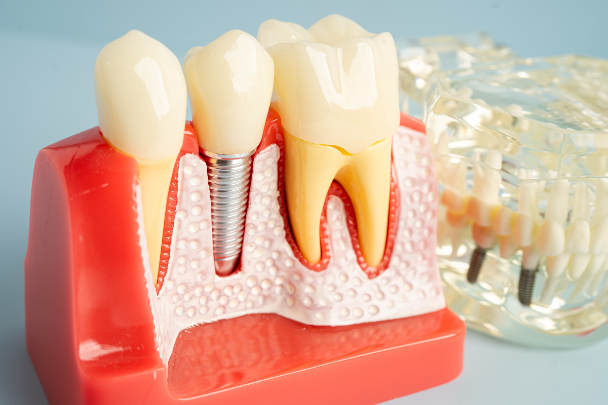 Dental Implant Procedure: What You Need to Know
