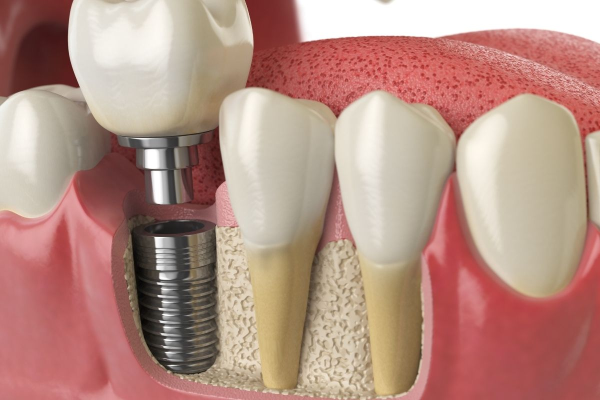 Dental Implants: Lifespan & Care Tips You Need to Know